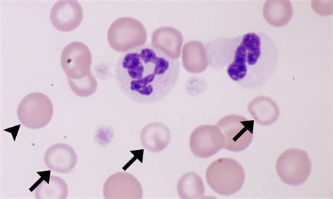Microcytes Cells And Smears