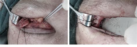 【孔宇：整理了关于泪腺脱垂的相关问题及治疗策略，希望对大家有所帮助（三）】 知乎