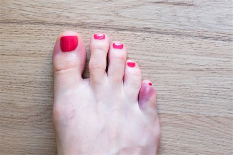 Broken Pinky Toe Treatment Effective Methods For Quick Healing