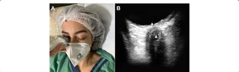 A The Nerve Optic Measured Through The Transorbital Window B Onsd Is Download Scientific