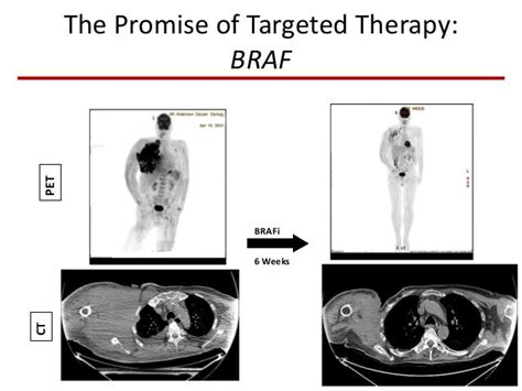 Targeted Therapy For Melanoma Dr Michael Davies
