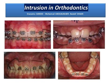 117 Intrusion In Orthodontics Oussama Sandid Mohamad Aboualnaser Moha
