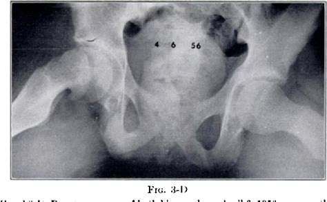 Figure 3 From Treatment Of Slipped Capital Femoral Epiphysis By Epiphyseodesis And Osteoplasty