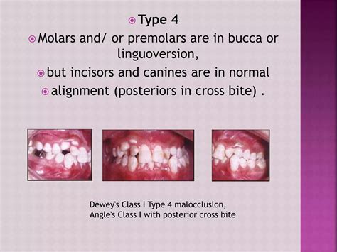 Classification Ofmalocclusion Ppt