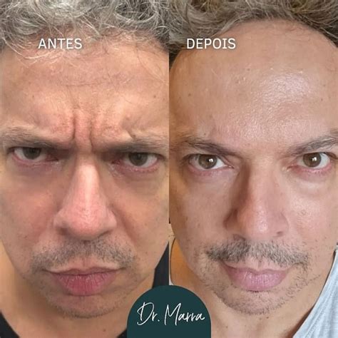 Início Do Ano Aumenta A Procura Por Botox Pelo Sexo Masculino
