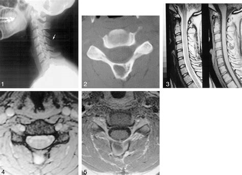 Simple Bone Cyst In Spinous Process Of The C4 Vertebra American