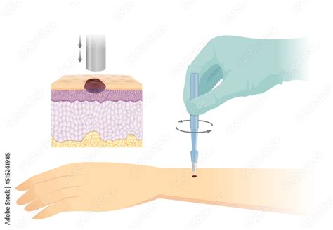 Use The Biopsy Punches Tool To Pierce Small Tissue Of Skin Layer For
