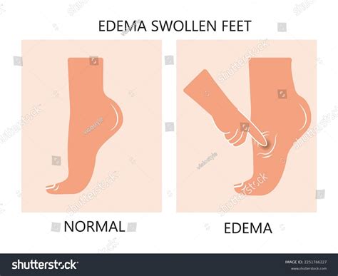 52 Vector Edema Lymph Edema Disease Swollen Leg Foot Images Stock