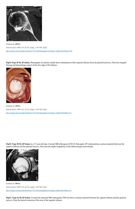 Normal Labral Variant Figures Ii Walif Chbeir Pdf