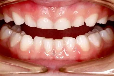 دندان قروچه علت و عوارض راهکار درمان لبخند درمان