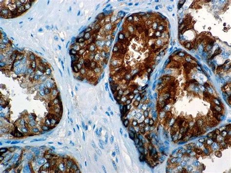 Alpha Fetoprotein Mmab Cancer Diagnostics Inc