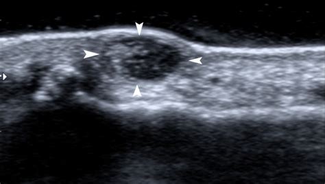 Subcutaneous Epidermoid Cyst At The Phalanges Arrowheads