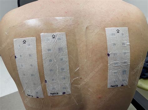 Allergy Patch Test Stock Image C059 9584 Science Photo Library