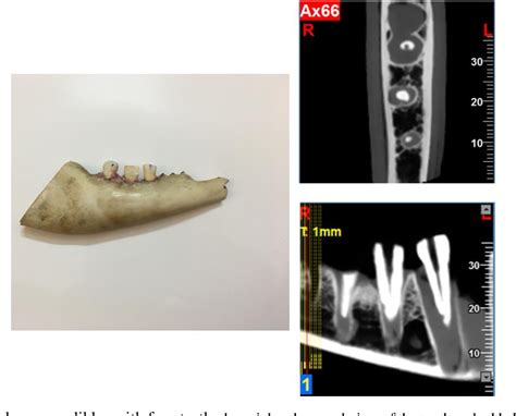 Figure 1 From Comparison Of The Accuracy Of Cbct Images And Apex Locator In Detection Of
