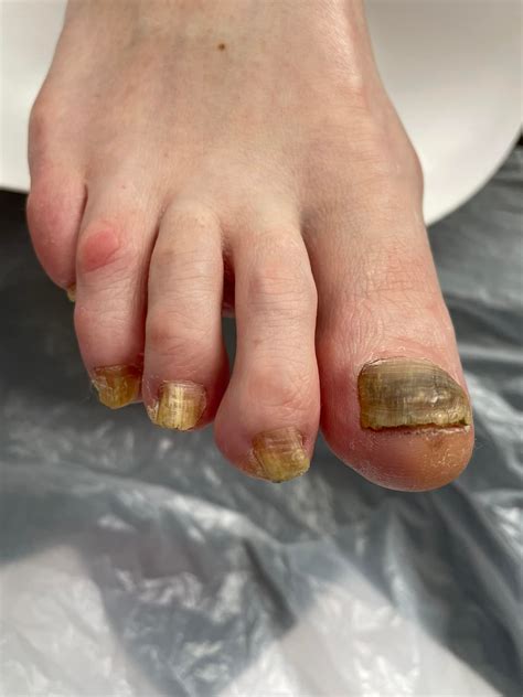 Heel My Feet Fungal Nail Infection Onychomycosis Or