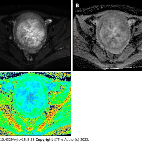 Magnetic Resonance Imaging Findings By Diffusion Weighted Images A An