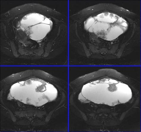 Multiseptate Cystic Mass With Solid Papillary Projections Appearance Download Scientific