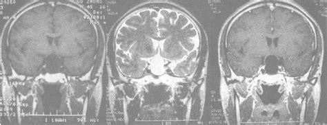 同病异像与异病同像——鞍区囊性病变的鉴别诊断 医学教育 医学