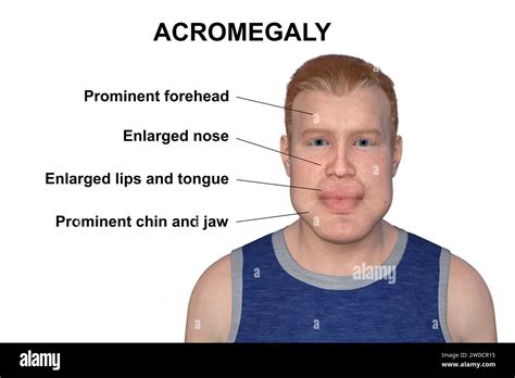 Acromegalia Antes E Depois