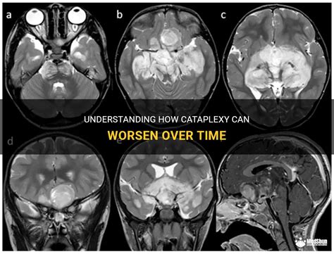 Understanding How Cataplexy Can Worsen Over Time MedShun