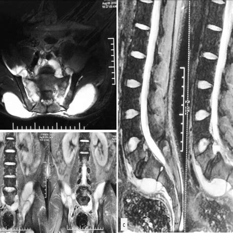 Pdf Tuberculosis Of Bilateral Sacroiliac Joints With Bilateral Psoas