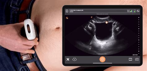 The Best 7 Portable Bladder Scanner In Canada 2025 Bladgo®