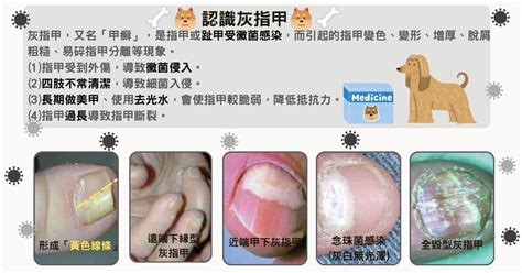汐止 幸湖診所 灰指甲，又叫「甲癬」，是指甲或趾甲被黴菌感染後，出現變色、變形、增厚、易碎等現象。 Facebook