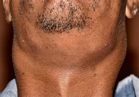 Clinical Presentation Showing Bilateral Lymphadenopathy Predominantly