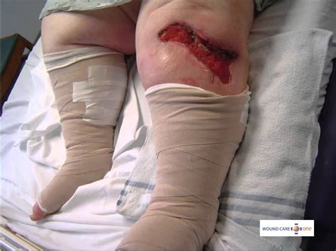 Granulation Tissue Plastic Surgery In Springfield Mo Reynolds Plastic Surgery