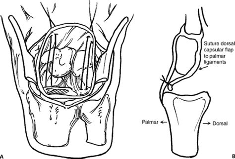 Proximal Row Carpectomy With Capsular Resurfacing Musculoskeletal Key