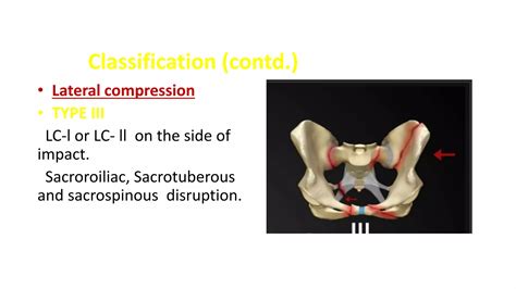 Classification Of Pelvic Fracture Pptx