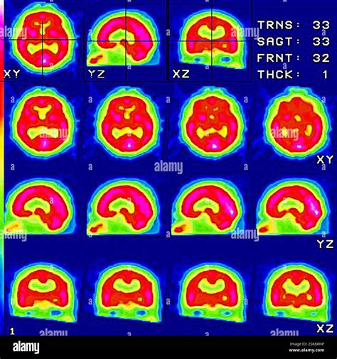 Healthy Brain Coloured Single Photon Emission Computed Tomography