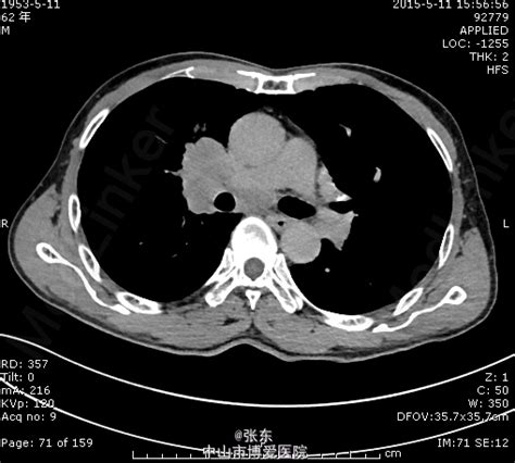 右肺粘液性腺癌侵犯纵膈血管 医联
