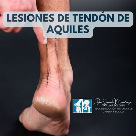 Lesiones Del Tendón De Aquiles
