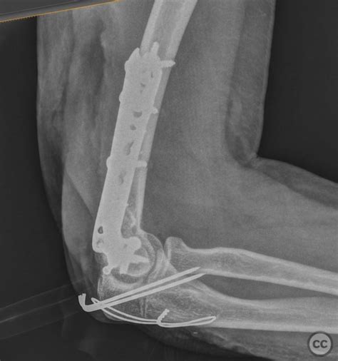 Displaced Intra Articular Distal Humerus Fracture With Olecranon Osteotomy