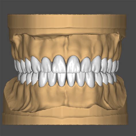 Stl File Dental Model In Articulator 🔧 ・3d Printer Model To Download