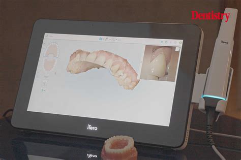 Lighting The Way Align Launches Itero Lumina Scanner Dentistry