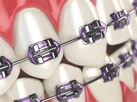 A Life With Braces What To Expect Orthodontic Center Of Santa