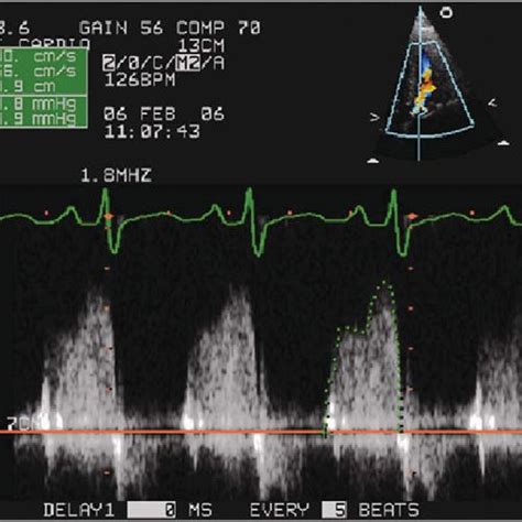 Supravalvular Mitral Ring Visualized From The Left Atrium Download