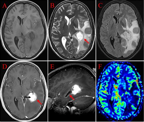 Intermediate Mass Brain