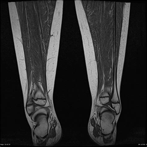 Congenital Myopathy Image