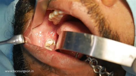 Surgical Wisdom Tooth Extraction By Specialist Oral Surgeon Dr Sunil