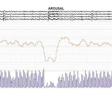 An Example Of An Electroencephalogram EEG Arousal With Associated Download Scientific