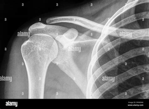 Clavicle Bone X Ray