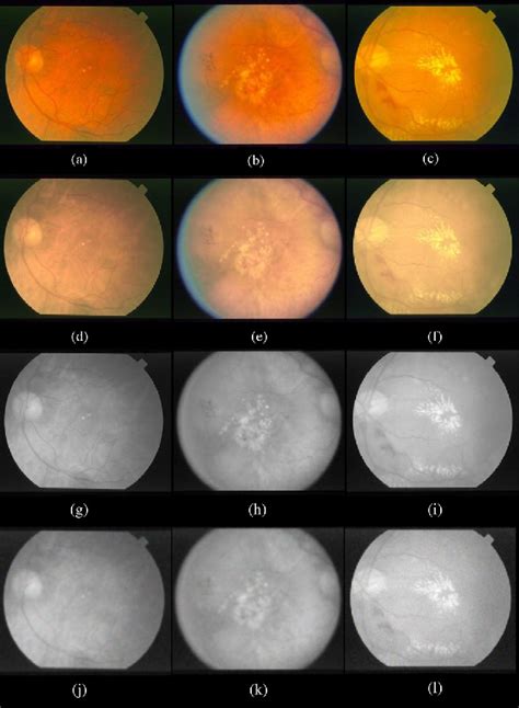 Table 1 From Automated Detection And Segmentation Of Drusen In Retinal