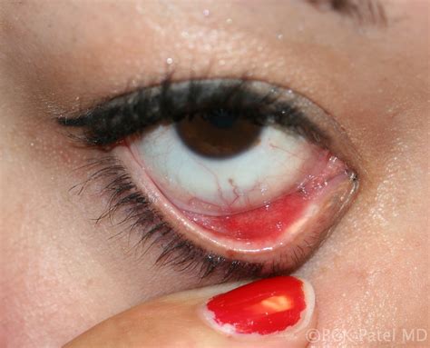 Chalazion Lower Eyelid