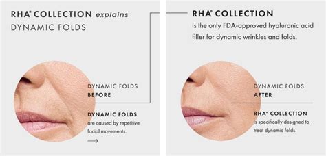 Rha Filler — Rejuve Medspa Newcastle Near Seattle Bellevue