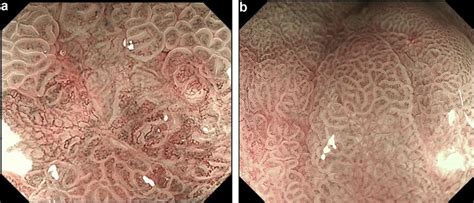 Convolutional Neural Network For The Diagnosis Of Early Gastric Cancer Based On Magnifying