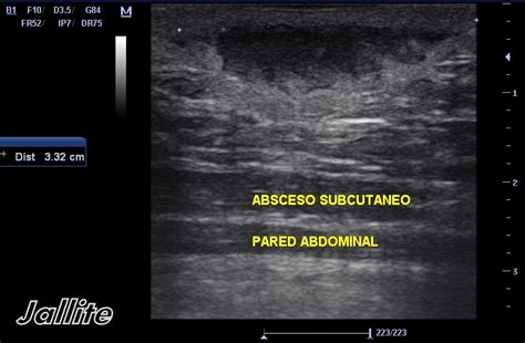 Absceso Pared Abdominal