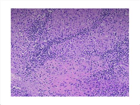 Pathology From Fine Needle Aspiration Of Mediastinal Lymph Node With